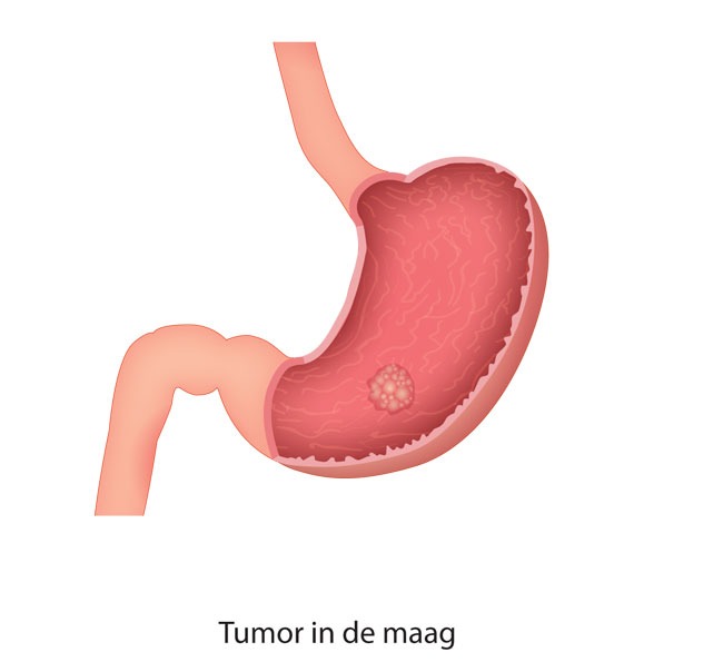 Biomarkers CEA en CA 19-9 voorspellen prognose maagkanker | mediamed