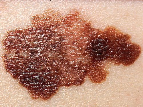 Neo-adjuvante immuuntherapie effectief bij uitgezaaid melanoom | mediamed