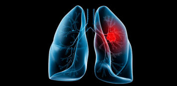 Voor- en nadelen van RATS vs. VATS voor segmentresectie | mediamed